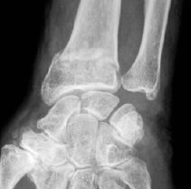 12 Poignet Fractures